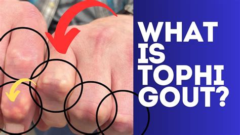 Tophi Gout Part 2 Tophaceous Tophi Gout Explained And Questions