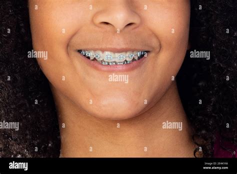 Zahnspange attraktiv jung teenager Fotos und Bildmaterial in hoher Auflösung Alamy