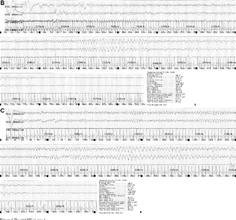 Figure 1 From Elongation Of Pulse Width As An Augmentation Strategy In Electroconvulsive Therapy