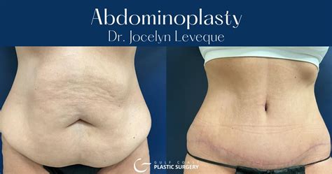 Before After Tummy Tuck • Dr Leveques Work Speaks For Itself