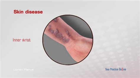 Lichen Planus Treatment Video Skin Disease Treatment