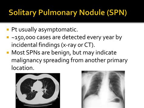 Lung Apex Nodule Lung Nodules Is A Lung Nodule Cancer