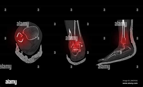 Ct Scan Ankle And Foot Or Computed Tomography Of Ankle Joint And Foot