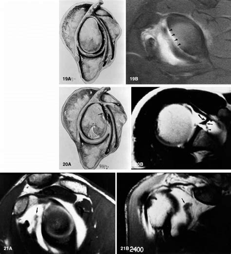 A B Anterosuperior Labral Tear A Drawing Shows A Tear Of The