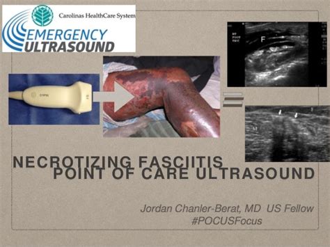 Finding Necrotizing Fasciitis In The Ed
