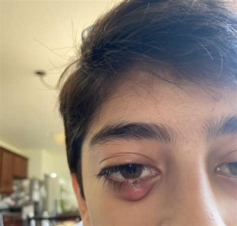 Cured Blepharitis R Blepharitis