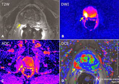 Mri Protocols Diffusion Weighted Mri Imaging Of The Prostrate Cancer