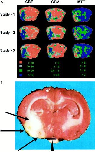 Perfusion Mapping Using Computed Tomography Allows Accurate Prediction Of Cerebral Infarction In