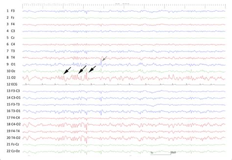 Interictal Scalp Eeg At 30 Days After The 1st Surgery Cortical Download Scientific Diagram