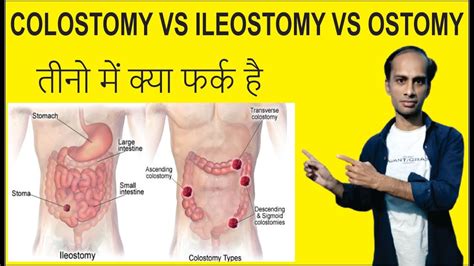 Ostomy Bag Vs Ileostomy At Dustin Heard Blog