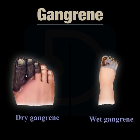 Docsteth On Linkedin Gangrene Drygangrene Wetgangrene Gasgangrene