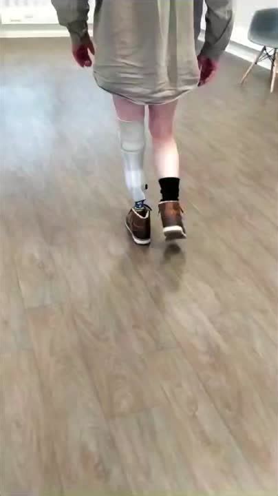 [video] Vytruve On Linkedin First Try And First Steps For This Tibial Amputee Patient 🦿 We Have…