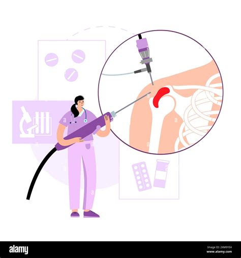 Illustration Of A Shoulder Arthroscopy Procedure This Is A Procedure For Diagnosing And