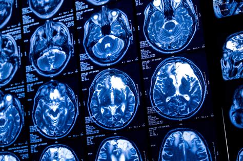 Camouflage Detection Boosts Neural Networks For Brain Tumor Diagnosis