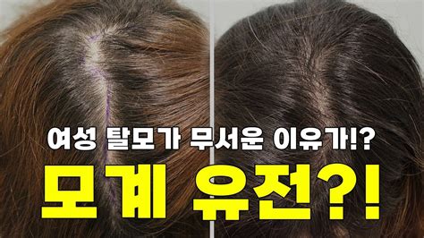 아빠보다 무서운 엄마의 탈모 모계유전 여성탈모가 무섭습니다 Youtube