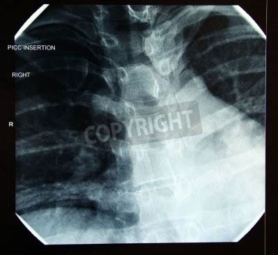 X Ray Of Correct Final Picc Peripherally Inserted Central Catheter Wall Mural Murals