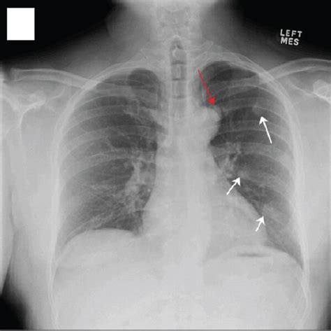 What Is A Nodular Density On Chest X Ray At Allen Rowe Blog