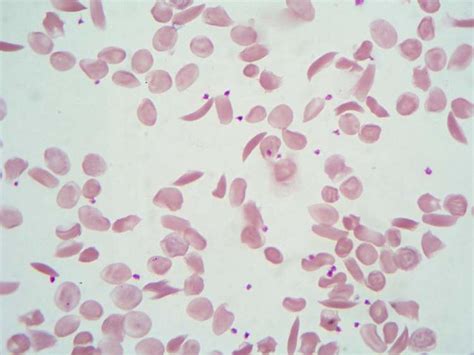 Eritrocitos Anormales