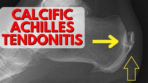 Calcific Achilles Tendinitis Treatment And Causes Youtube