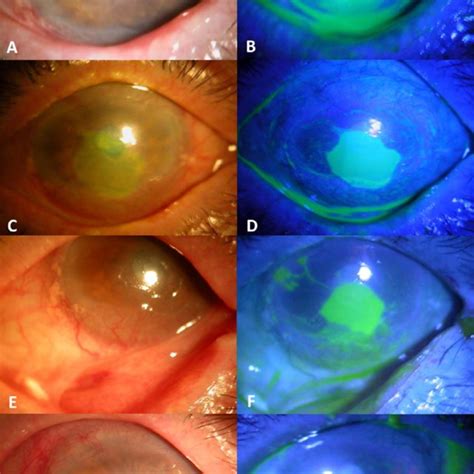 Clinical Course Of Case 3 The Refractory Corneal Epithelial Defect In Download Scientific