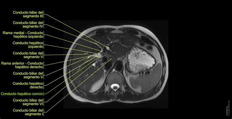 Colangiopancreatografía Por Resonancia Magnética Anatomía Normal E