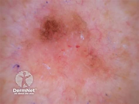 Lichenoid Keratosis Image