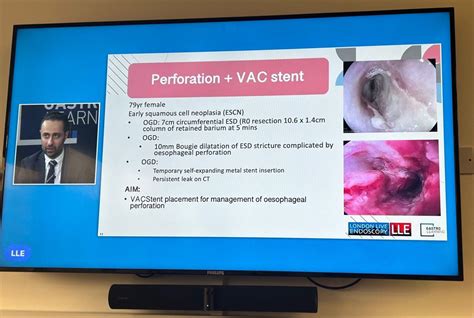 Londonlive Eyemax Vacstent Endoscopy Microtechuk
