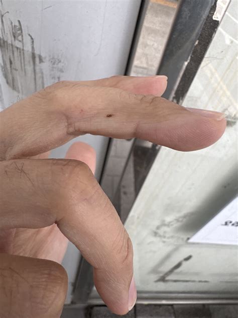 갑자기 손가락에 점이 생겼는데 병원에 가봐야 할까요 ㅣ 궁금할 땐 아하