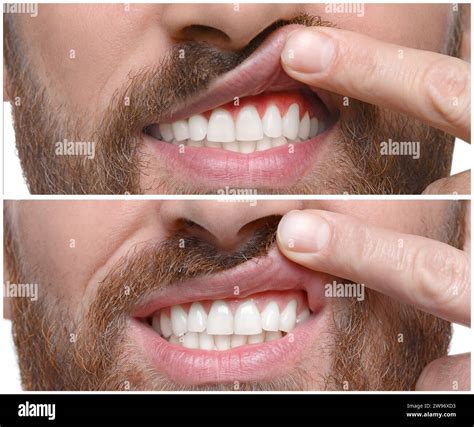 Man Showing Gum Before And After Treatment Collage Of Photos Stock Photo Alamy