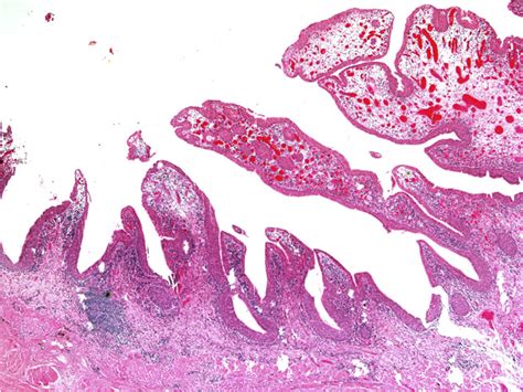 Figure 1 From Polypoidpapillary Cystitis Semantic Scholar