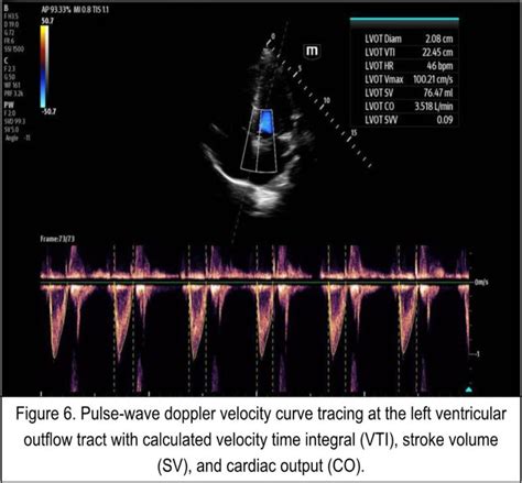 Us Probe Velocity Time Integral Vti In Sepsis Management Emdocs