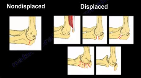 Dr Nabil Ebraheims Blogspot Olecranon Fractures