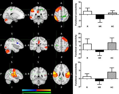 Increased Pre Treatment Functional Connectivity Between A Right Download Scientific Diagram