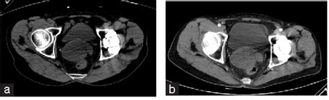 Seminal Vesicle Cystadenoma Semantic Scholar
