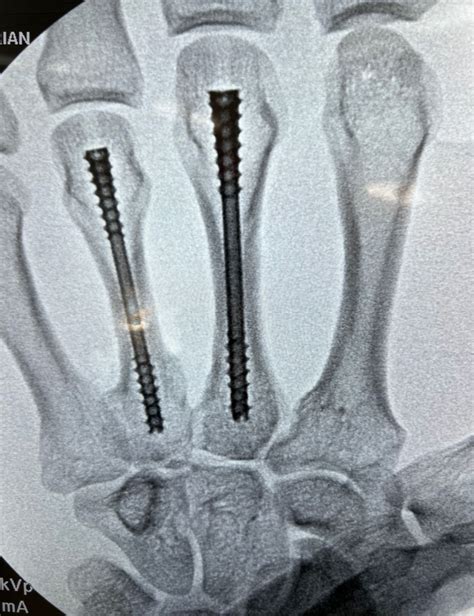 Patryk J Kania On Linkedin Great To See Fos Anatomical Metacarpal Nx Nail Benefiting More And
