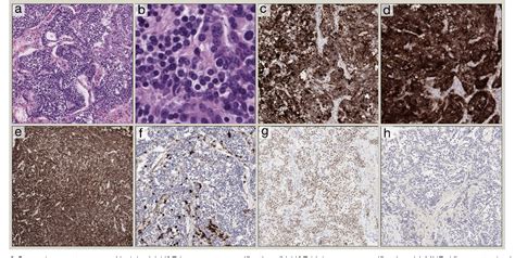 Figure 2 From A Very Rare Case Of Synchronous Primary Lung Cancer Lymph