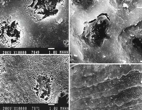 Enamel Etching Pocket Dentistry