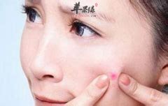 长痘痘不能吃的食物有哪些 苹果绿