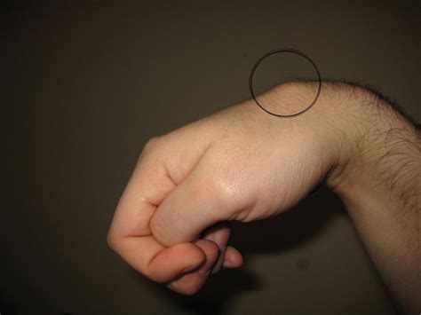 Protuberancia Carpometacarpiana Carpometacarpal Bossing Qazwiki