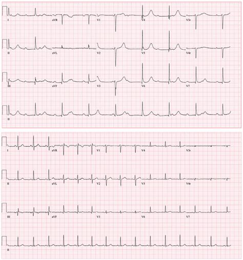 Complete Atrioventricular Block With Junctional Escape At 50 Beats Min