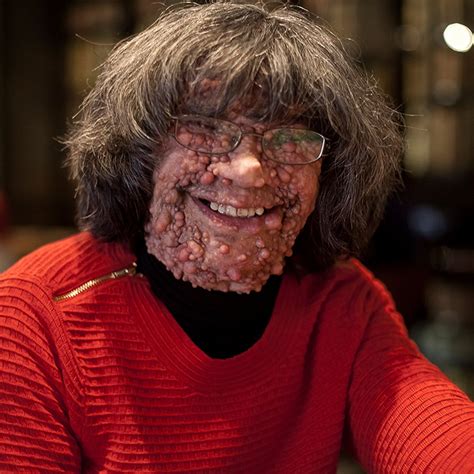 Thriving With Neurofibromatosis Back Neurofibromatosis