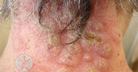 Acute Neutrophilic Dermatosis Image