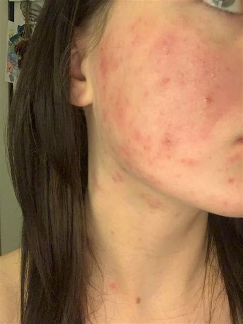 Itchy And Hot Rash With Swollen Lymph Nodes Only On One Side Of My Face R Dermatologyquestions