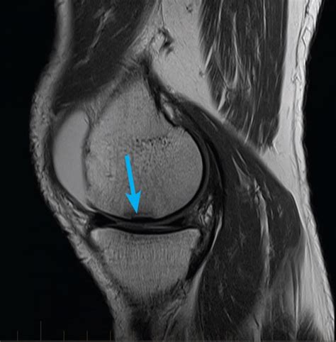 Meniscal Zones Radiology At Robin Bradley Blog