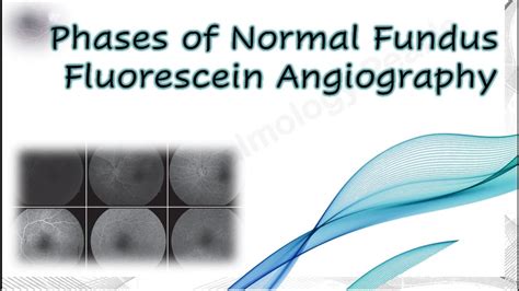 Phases Of Normal Fundus Fluorescein Angiography Youtube