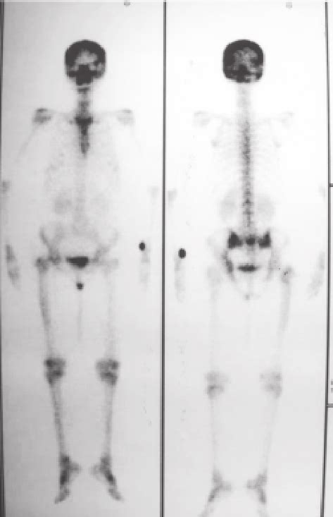 Technetium 99m Bone Scan Showing Intense Uptake In The Skull Left Download Scientific Diagram