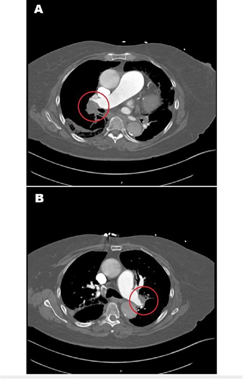A Right Pulmonary Embolus B Left Pulmonary Embolus Download Scientific Diagram