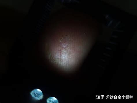 自己得了跖疣治疗过程分享 知乎
