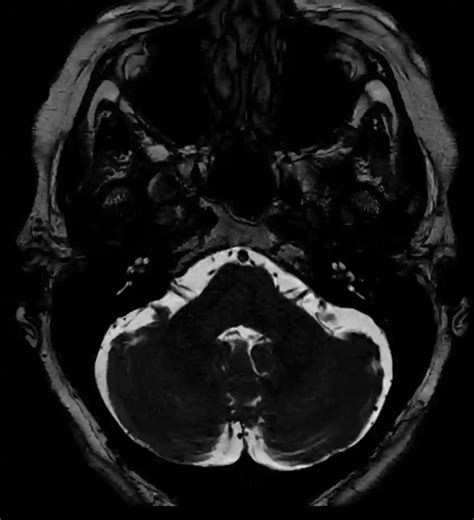 Ciss Sequence Mri Ars Neurochirurgica