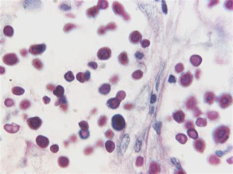 Americans With Aids Should Be Screened For Cryptococcus Americans With Aids Should Be Screened For Cryptococcus